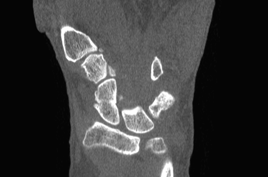 CT Confirms Scaphoid Fracture Union Quicker than X-Ray - CurveBeam